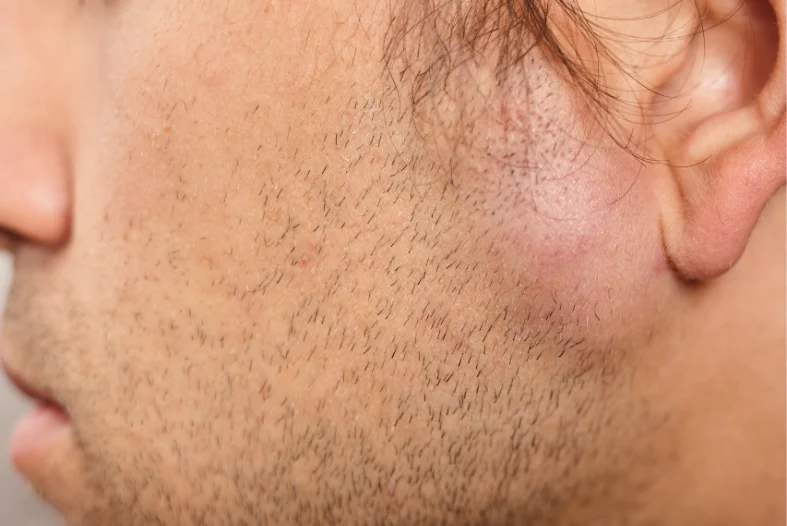 Lipoma Treatment in Forney & Plano, TX | Evolve Dermatology