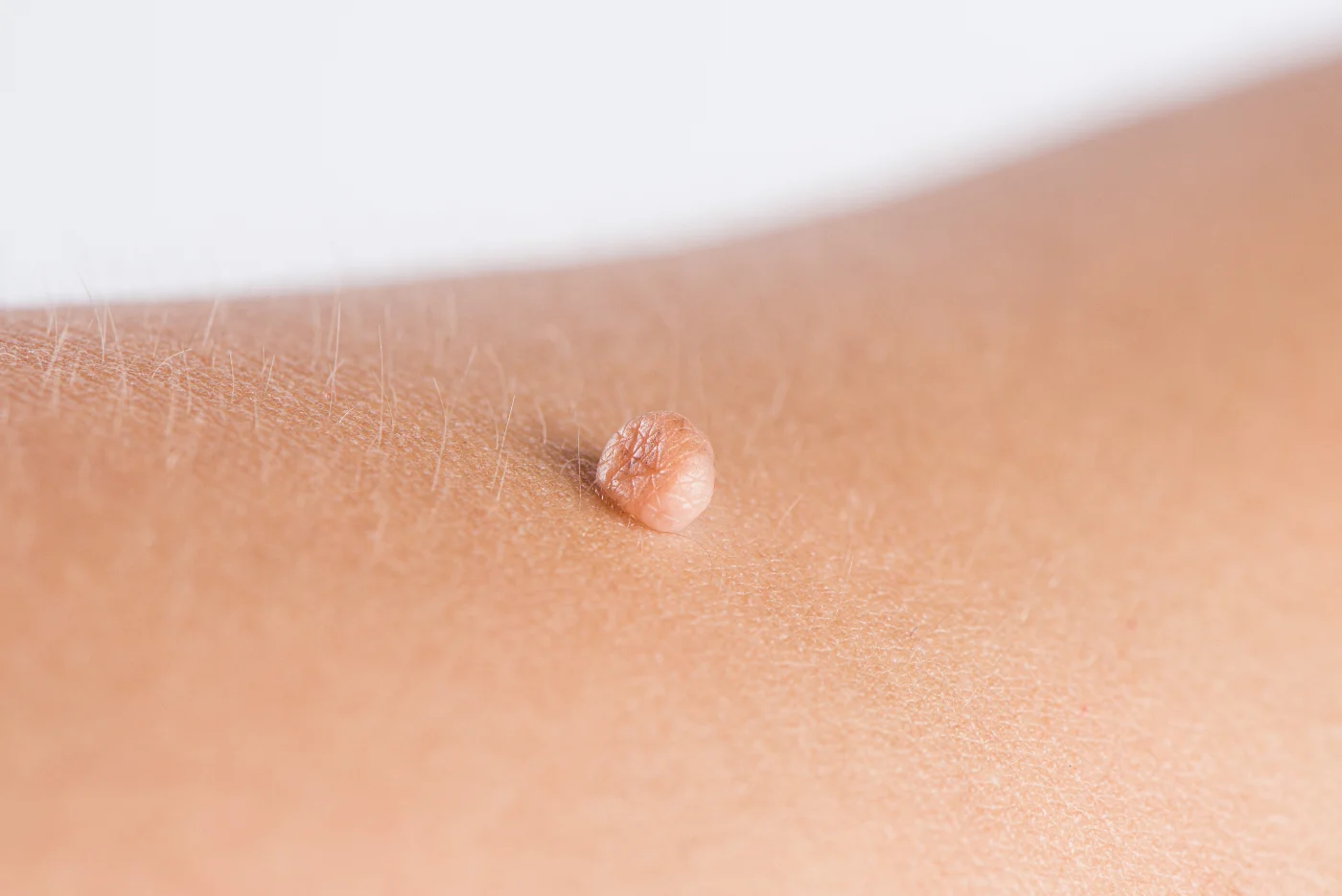 Skin Tags in Forney & Plano, TX | Evolve Dermatology